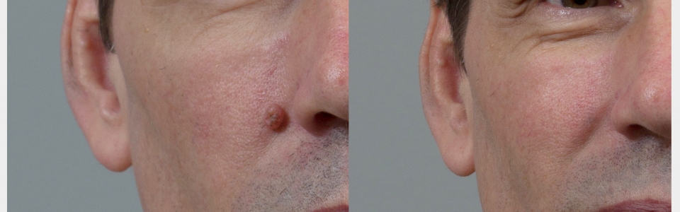 CO2 Laser Skin Resurfacing in Birmingham, AL | Seiler Skin